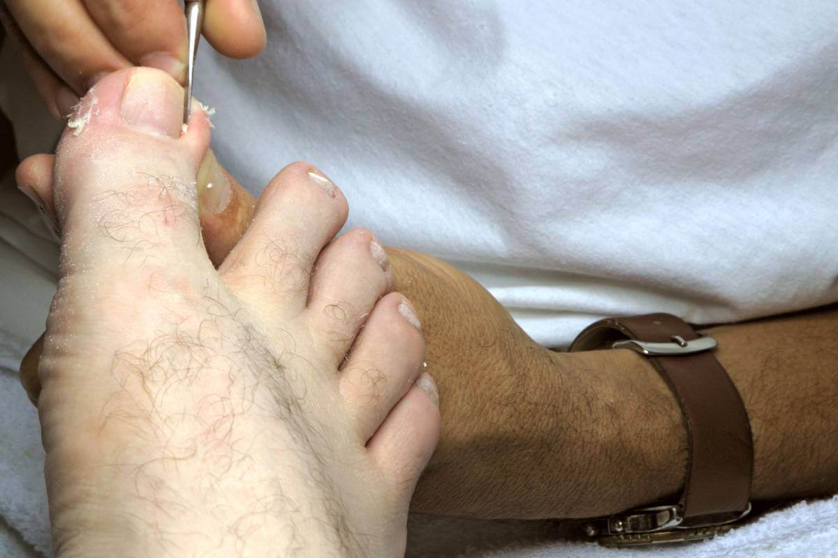 Ingrown Toenail Procedure | Launceston Podiatrist