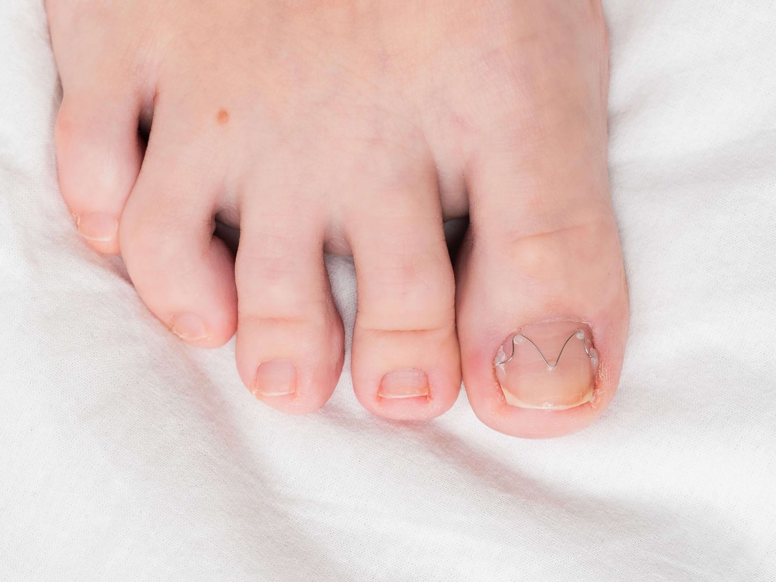 Ingrown Toenail Procedure | Launceston Podiatrist